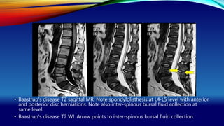 Baastrup syndrome Dr. Muhammad Bin Zulfiqar | PPTX