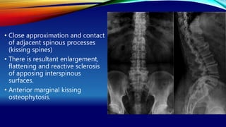 Baastrup syndrome Dr. Muhammad Bin Zulfiqar | PPTX