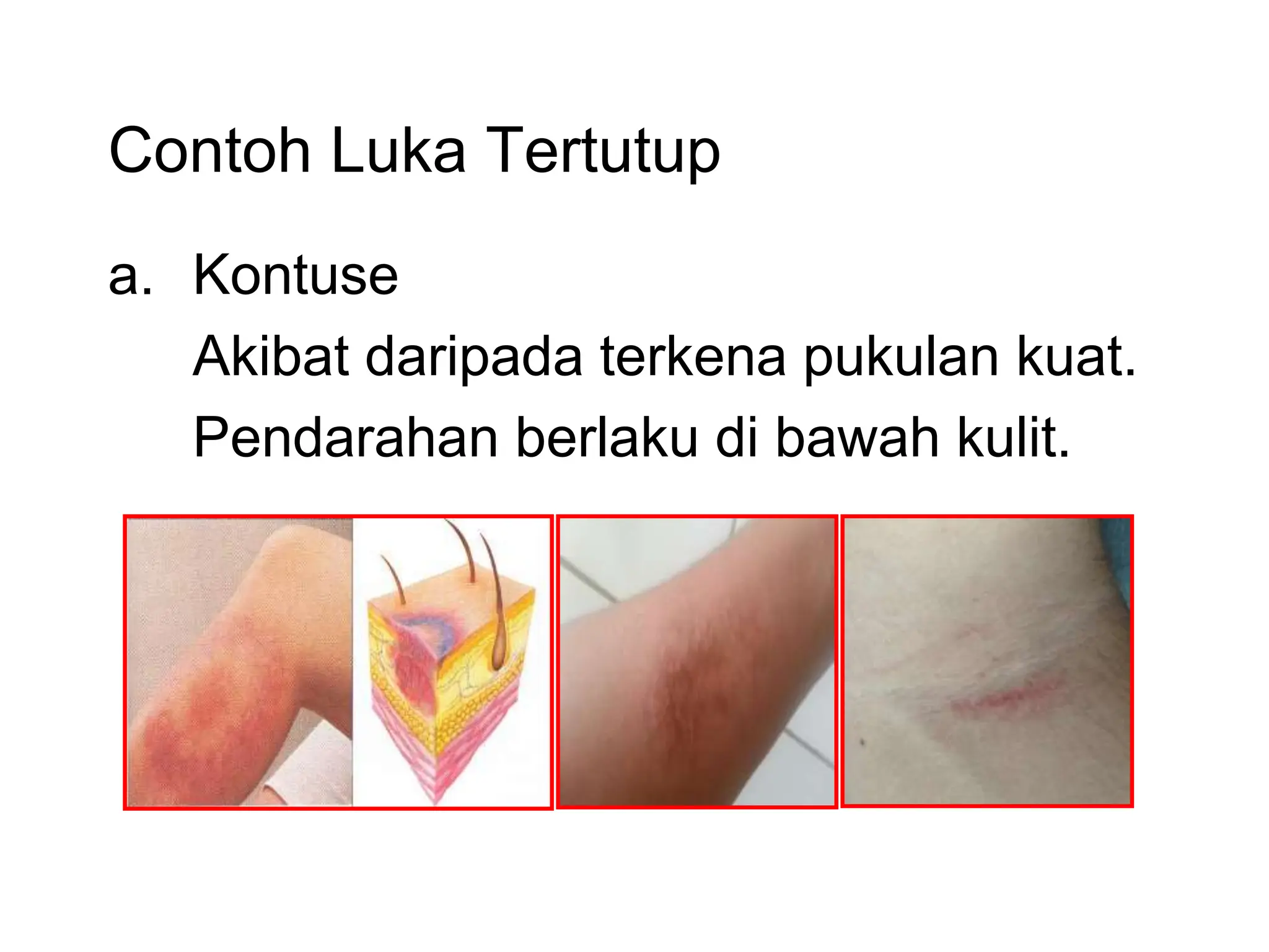 BAB 1 LUKA DAN PENDARAHAN DALAM PERTOLONGAN CEMAS | PPT