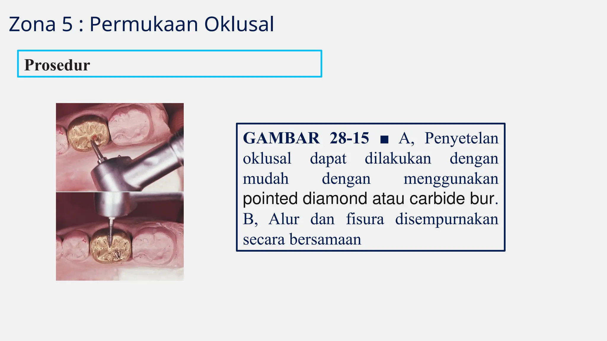 BAB 28.pptx finishising cast crown pada prostodonsia | PPTX