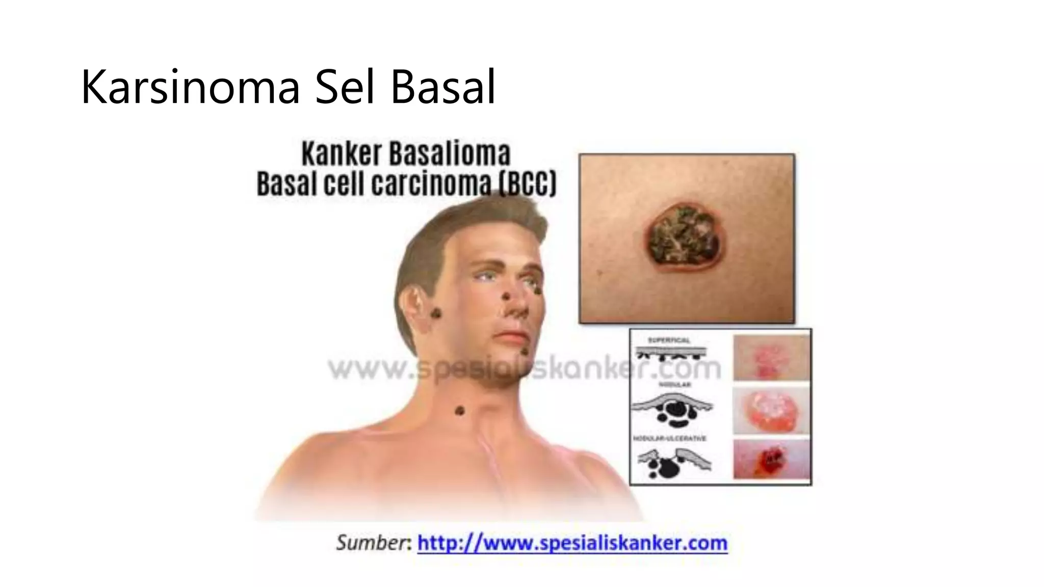 Bab 3 konsep dasar neoplasma sesi 1-dr,herlin RMIK POLITEKNIK BAUBAU.pptx