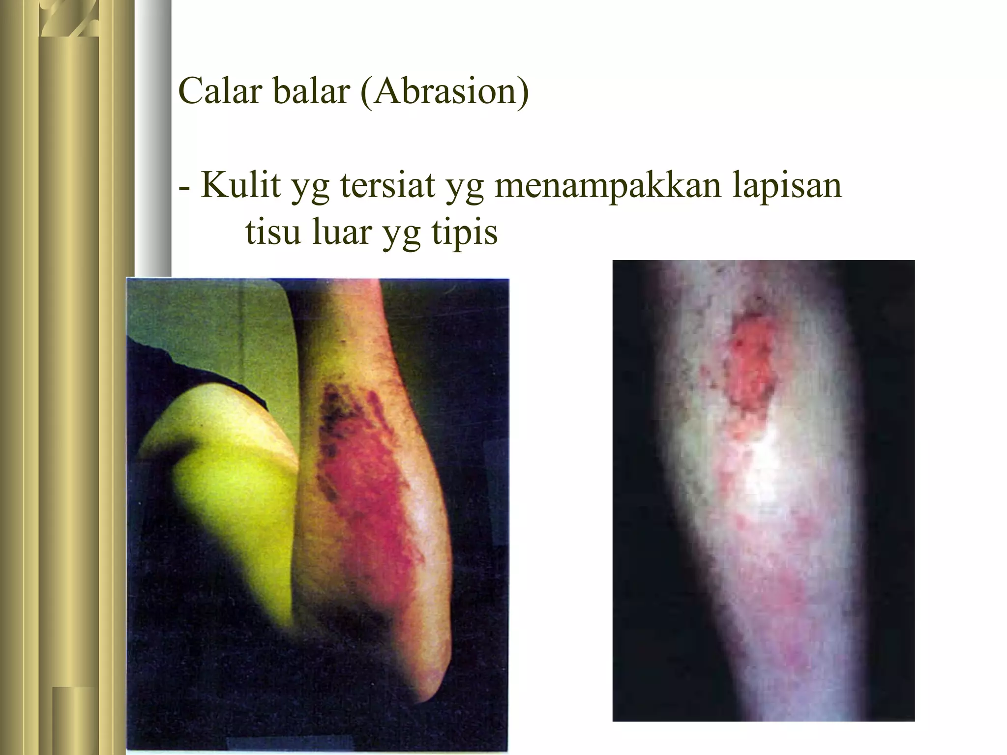 Bab 5 luka & patah | PPT