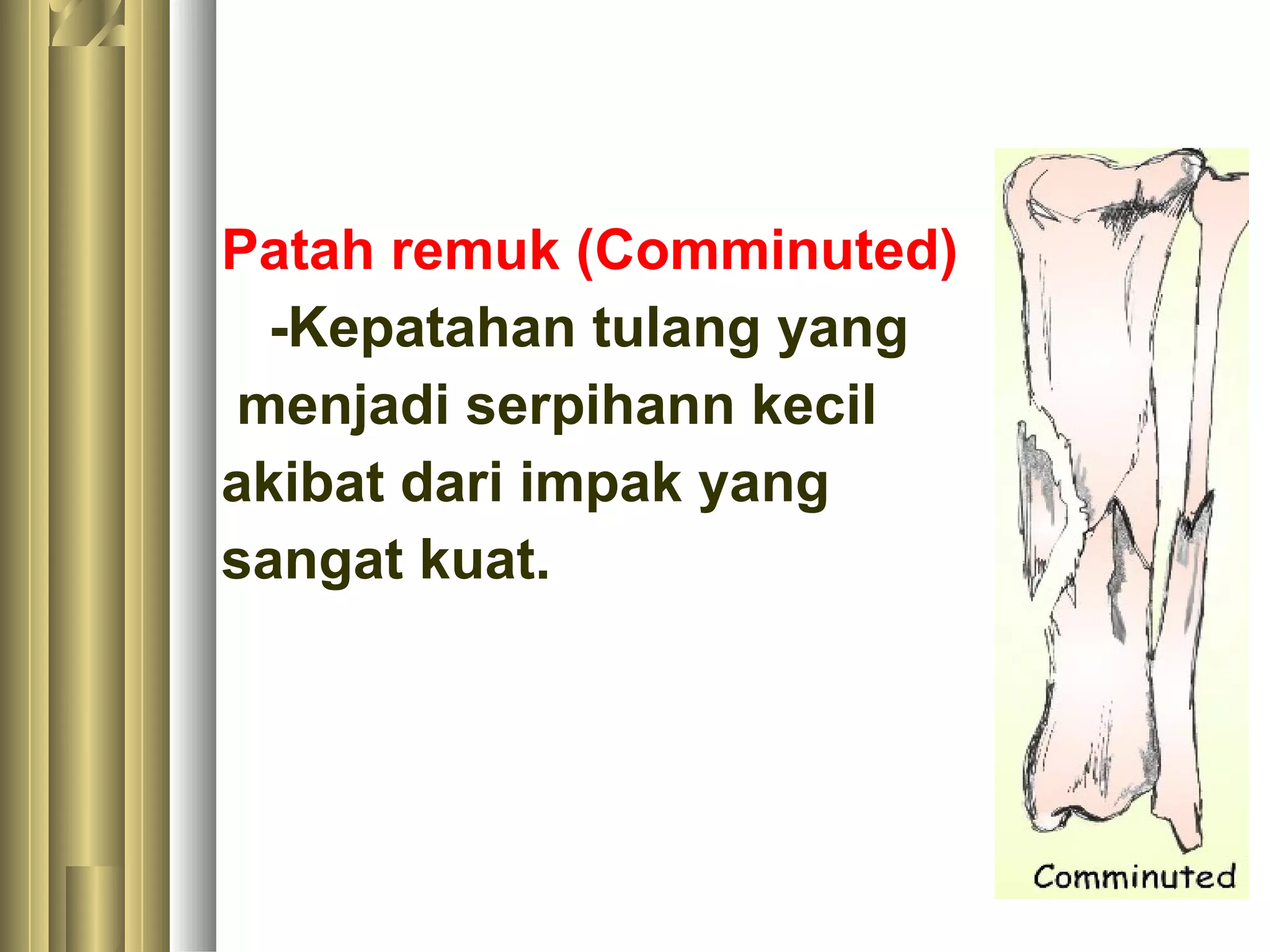Bab 5 luka & patah | PPT
