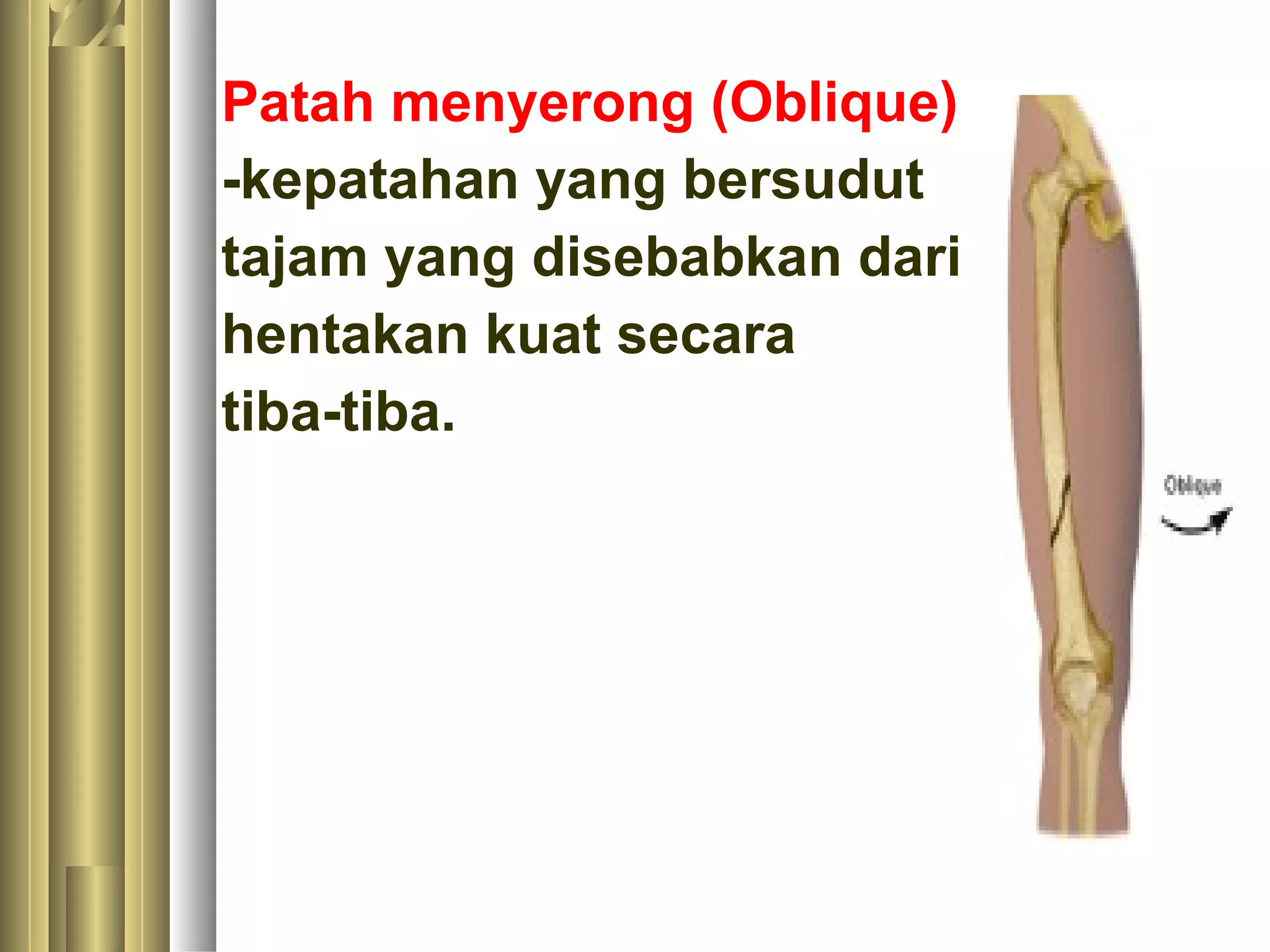 Bab 5 luka & patah | PPT