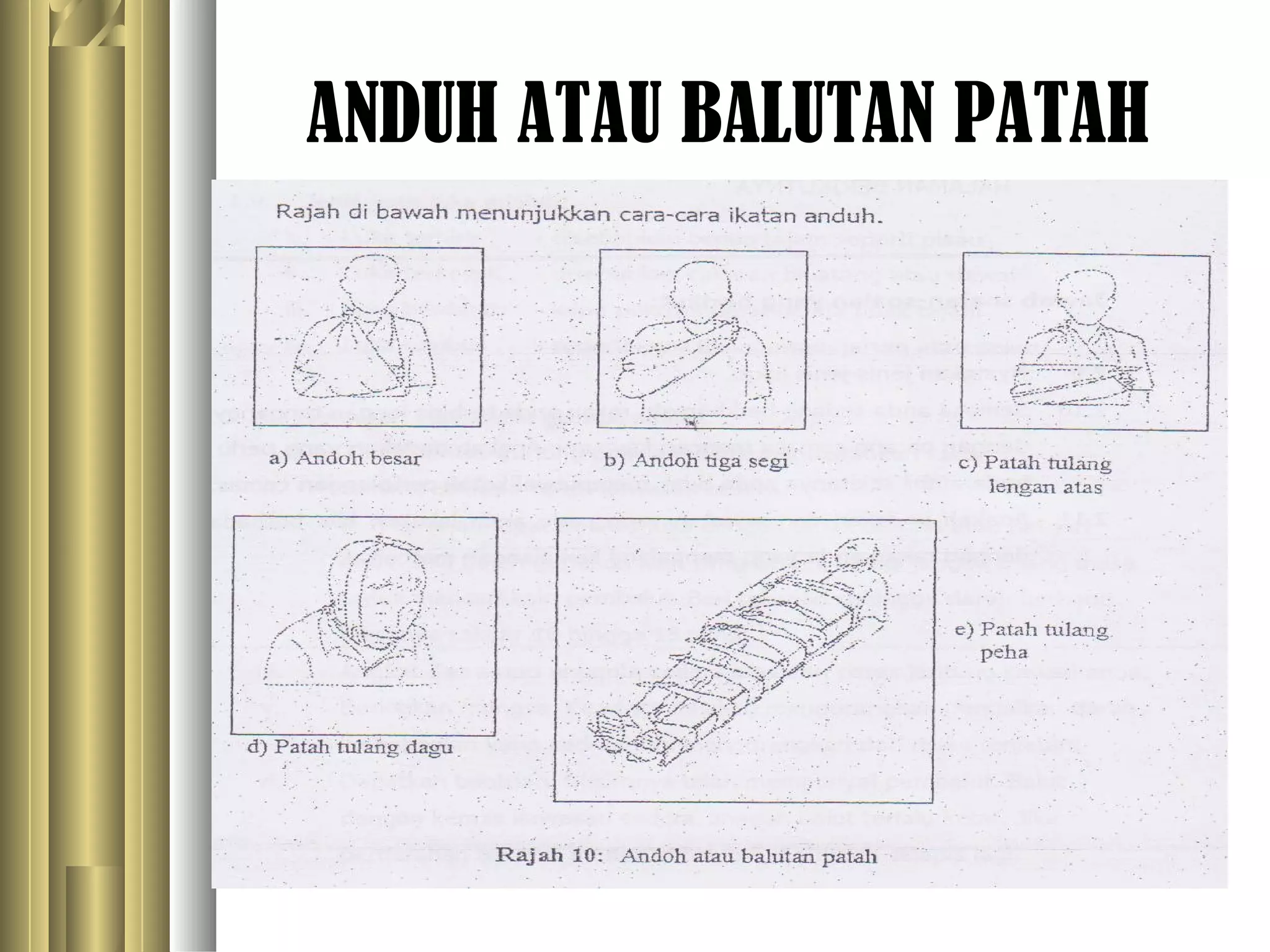 Bab 5 luka & patah | PPT