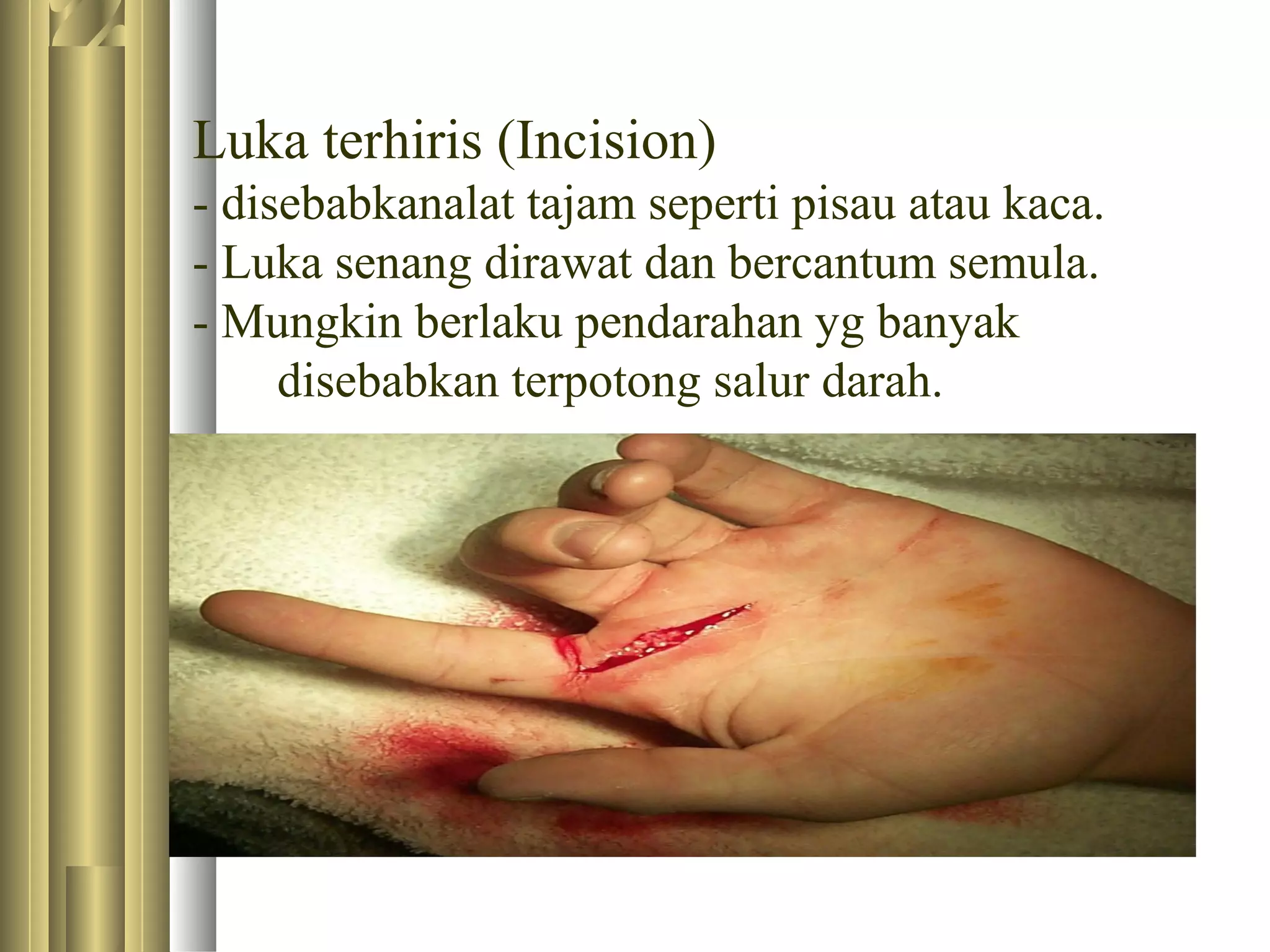 Bab 5 luka & patah | PPT