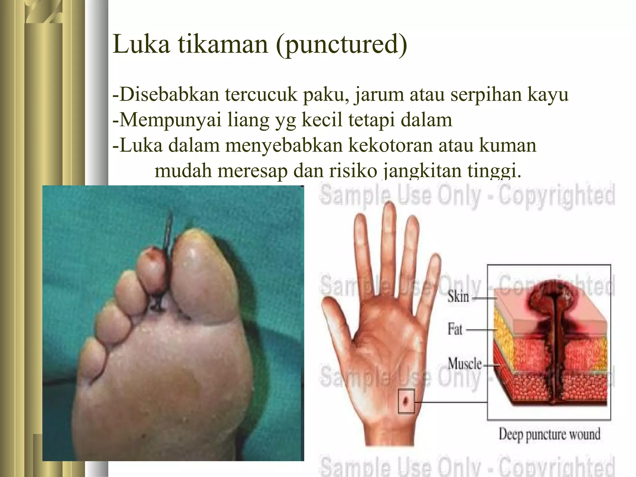 Bab 5 luka & patah | PPT