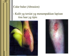 Bab 5 luka & patah | PPT