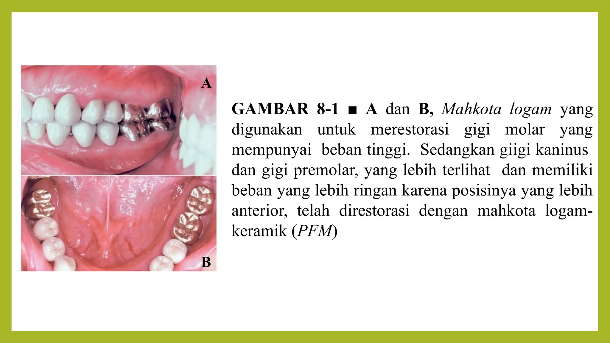 Bab 8 Dedi The complete Cast Crown Preparation.pptx