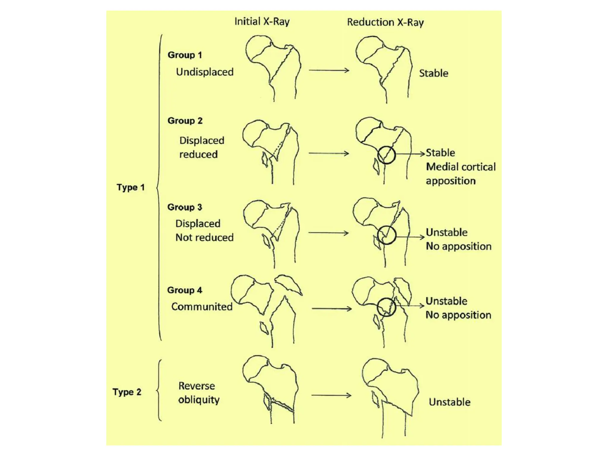 unstable trochanteric fracture | PPTX