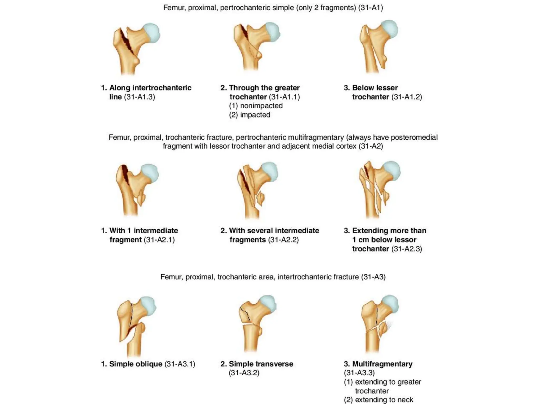 unstable trochanteric fracture | PPTX