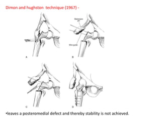 unstable trochanteric fracture | PPTX