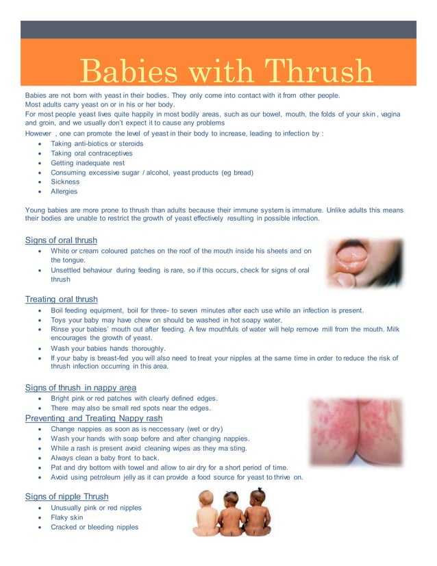 Babies with thrush | PDF