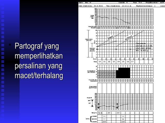 BAB IIa Partograf pada persalinan normal | PPT