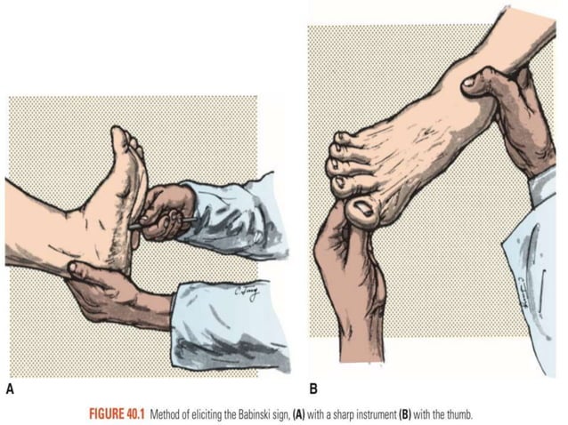 Babinski Sign | PPT