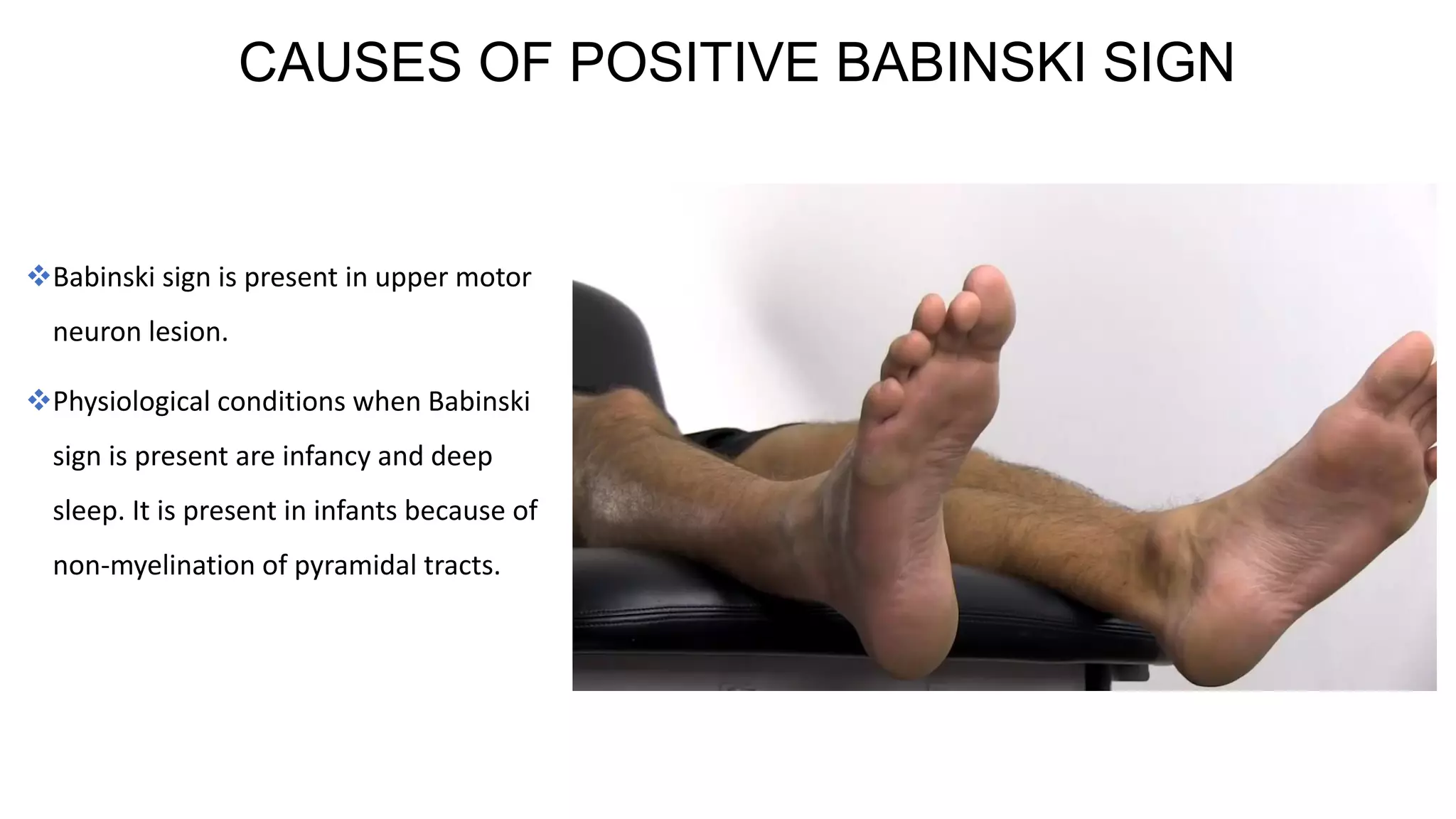 Babinski sign | PDF