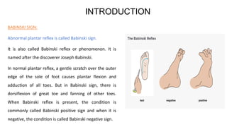 Babinski sign | PDF