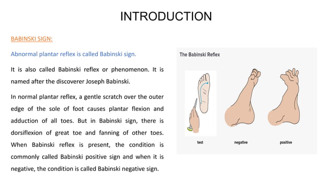 Babinski sign | PDF