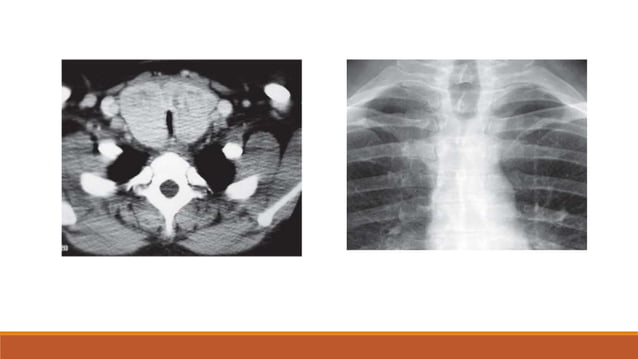 large airway presentation.pptx