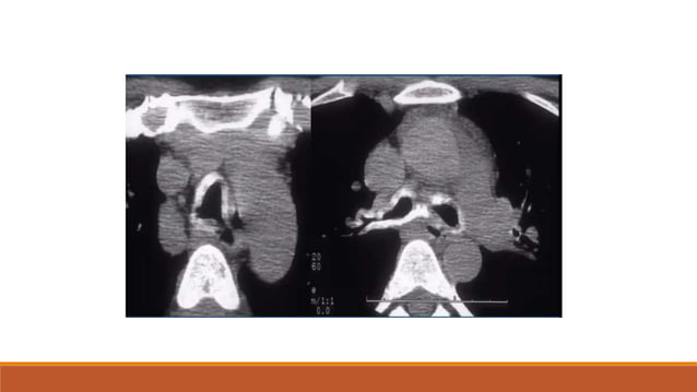 large airway presentation.pptx