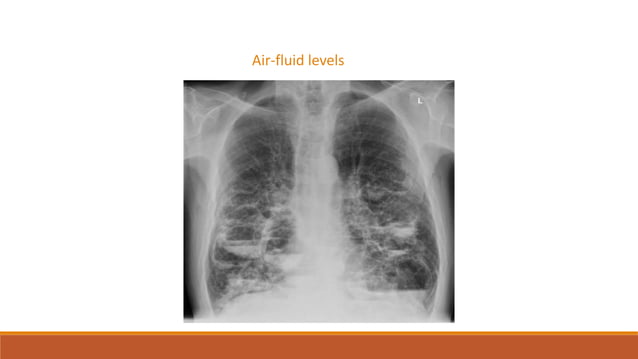 large airway presentation.pptx