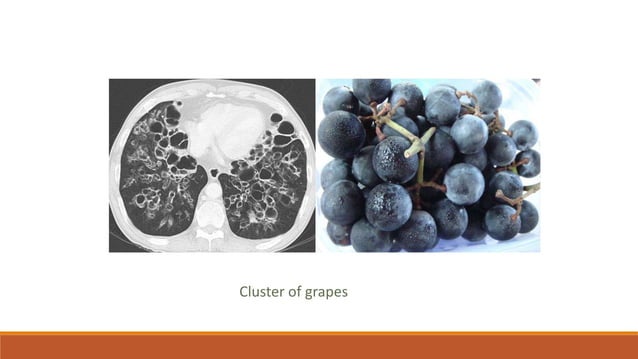 large airway presentation.pptx
