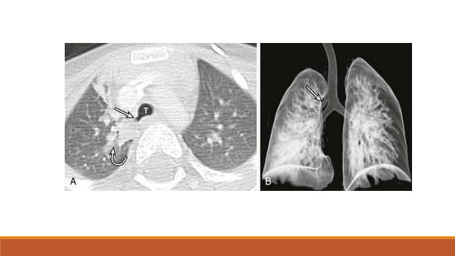 large airway presentation.pptx