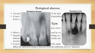 Sequelae of dental caries | PPTX