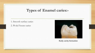 Sequelae of dental caries | PPTX