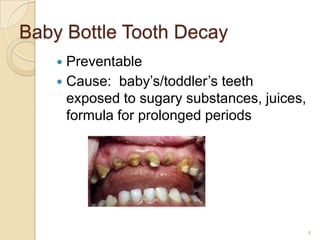 Baby bottle tooth decay | PPTX
