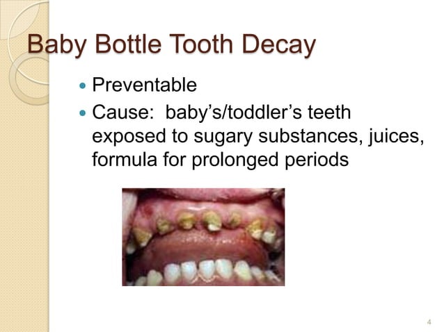 Baby bottle tooth decay | PPT