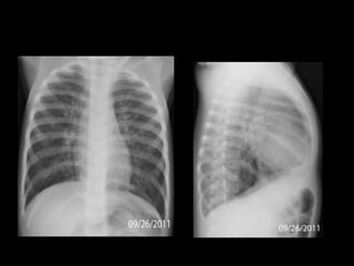 Neonatal Pneumonia | PPTX