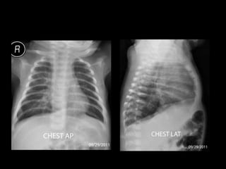 Neonatal Pneumonia | PPTX