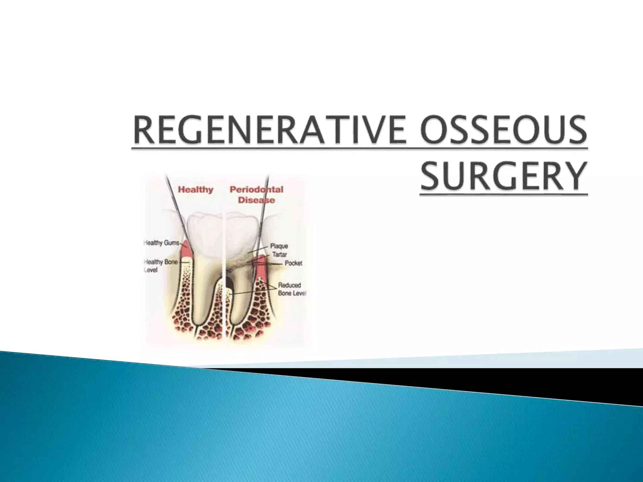 Regenerative osseous surgery | PPTX