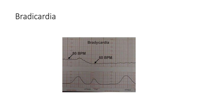 Baby's heart rate | PPT