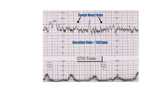 Baby's heart rate | PPT