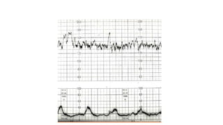 Baby's heart rate | PPT