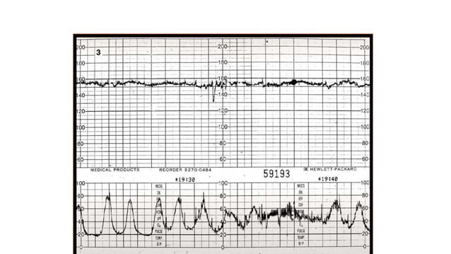 Baby's heart rate | PPT