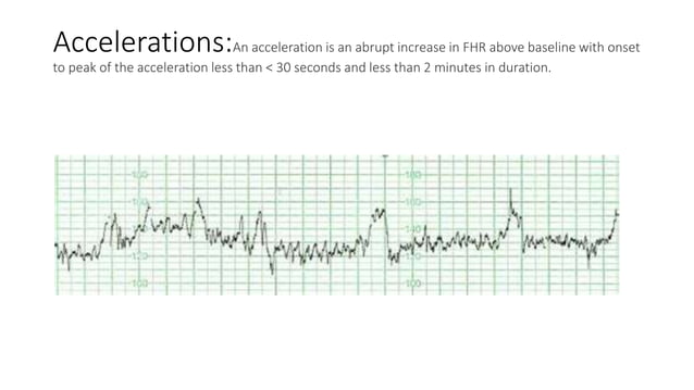 Baby's heart rate | PPT