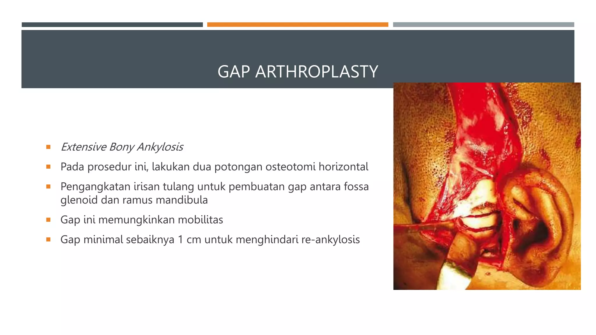 BACAAN KL ANKYLOSIS TMJ.pptx