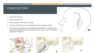 BACAAN KL ANKYLOSIS TMJ.pptx