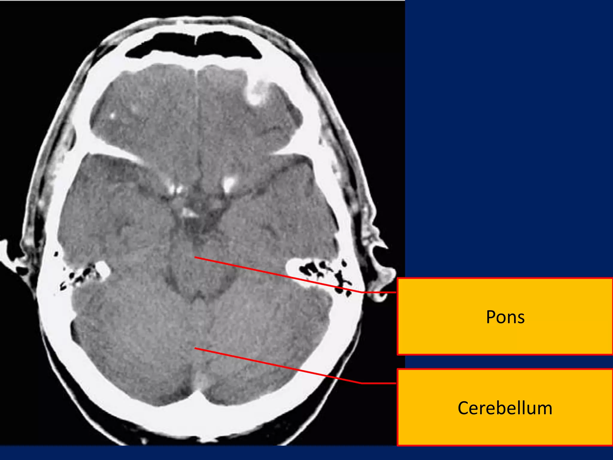 Baca ct scan | PPTX