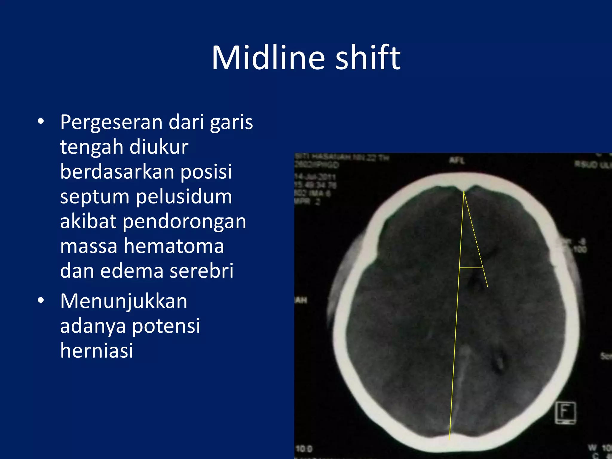 Baca ct scan | PPTX