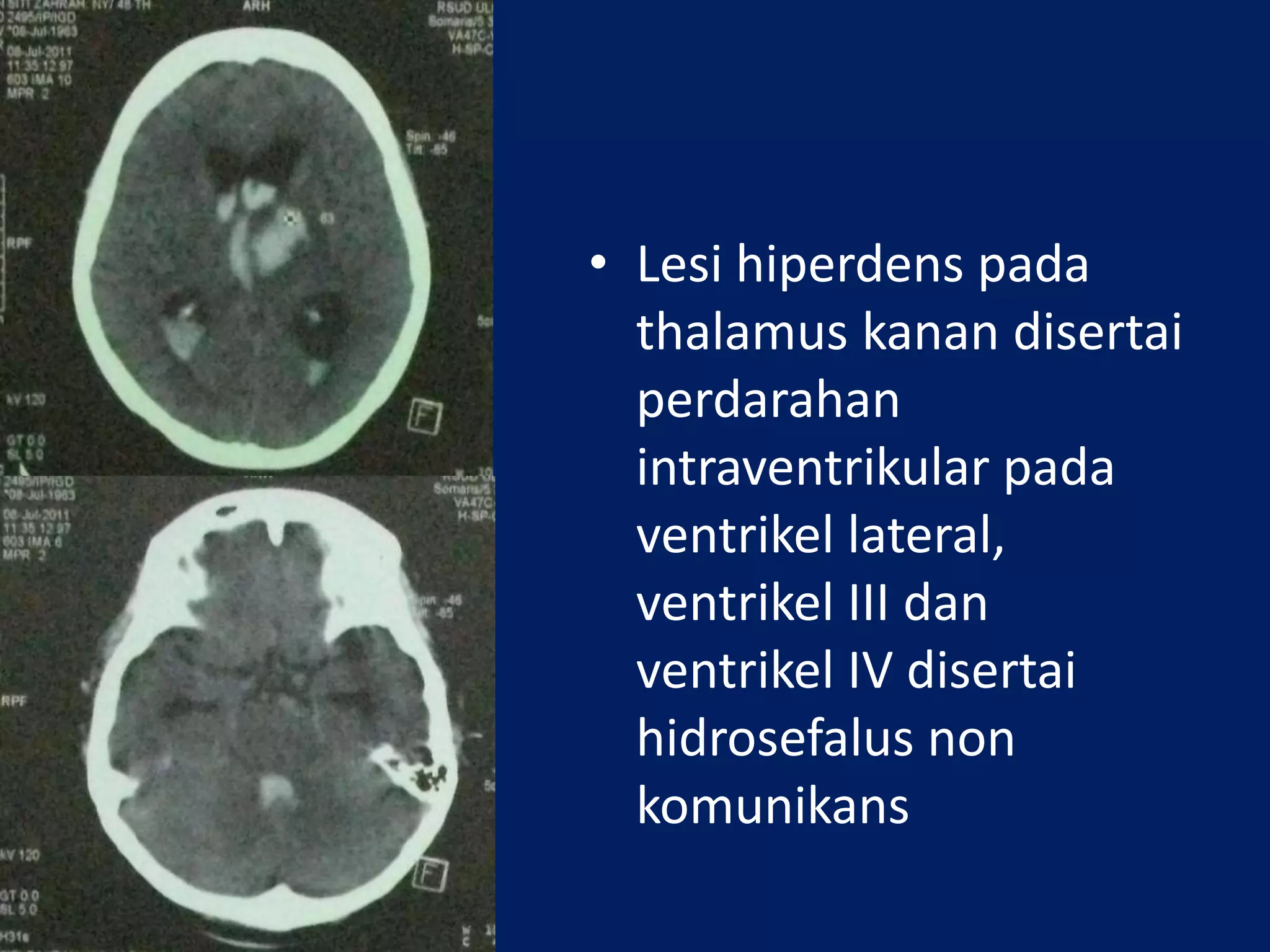 Baca ct scan | PPTX
