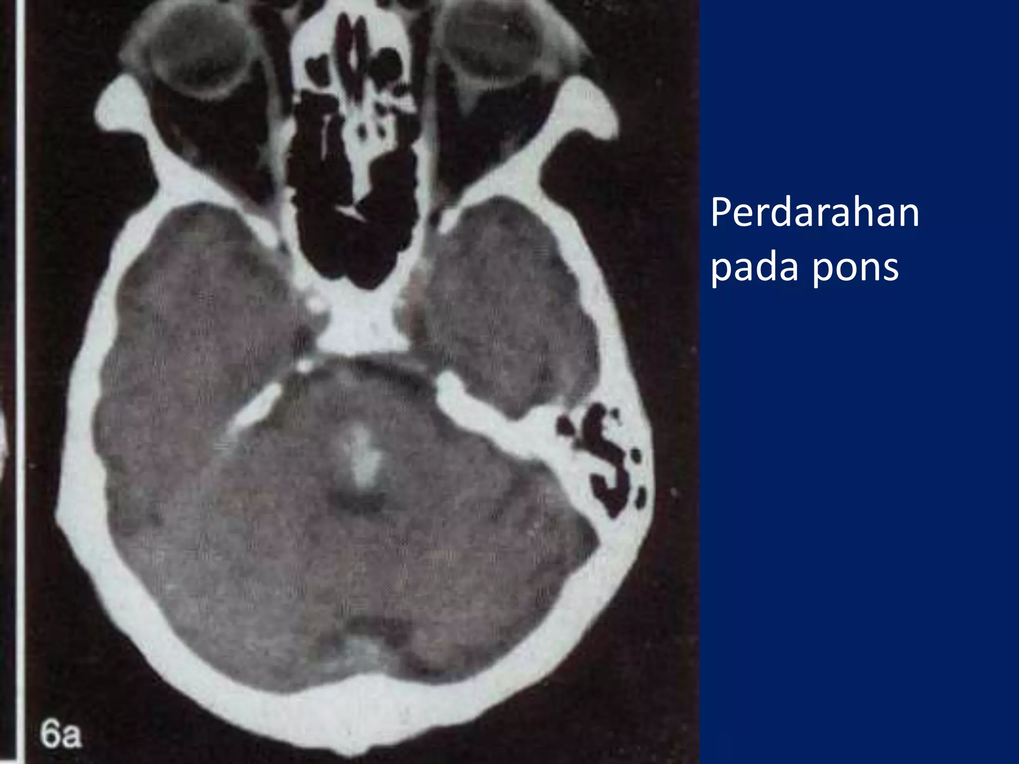 Baca ct scan | PPTX