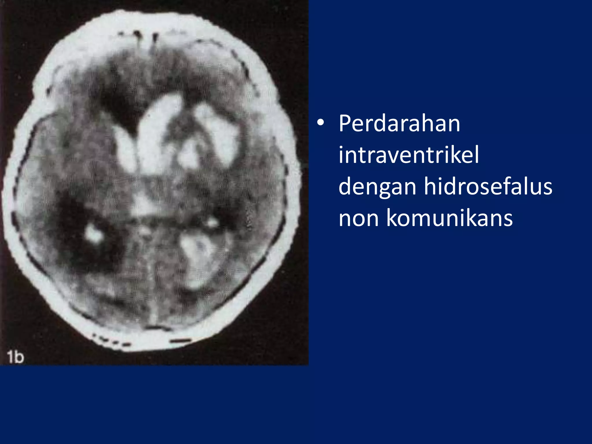 Baca ct scan | PPTX