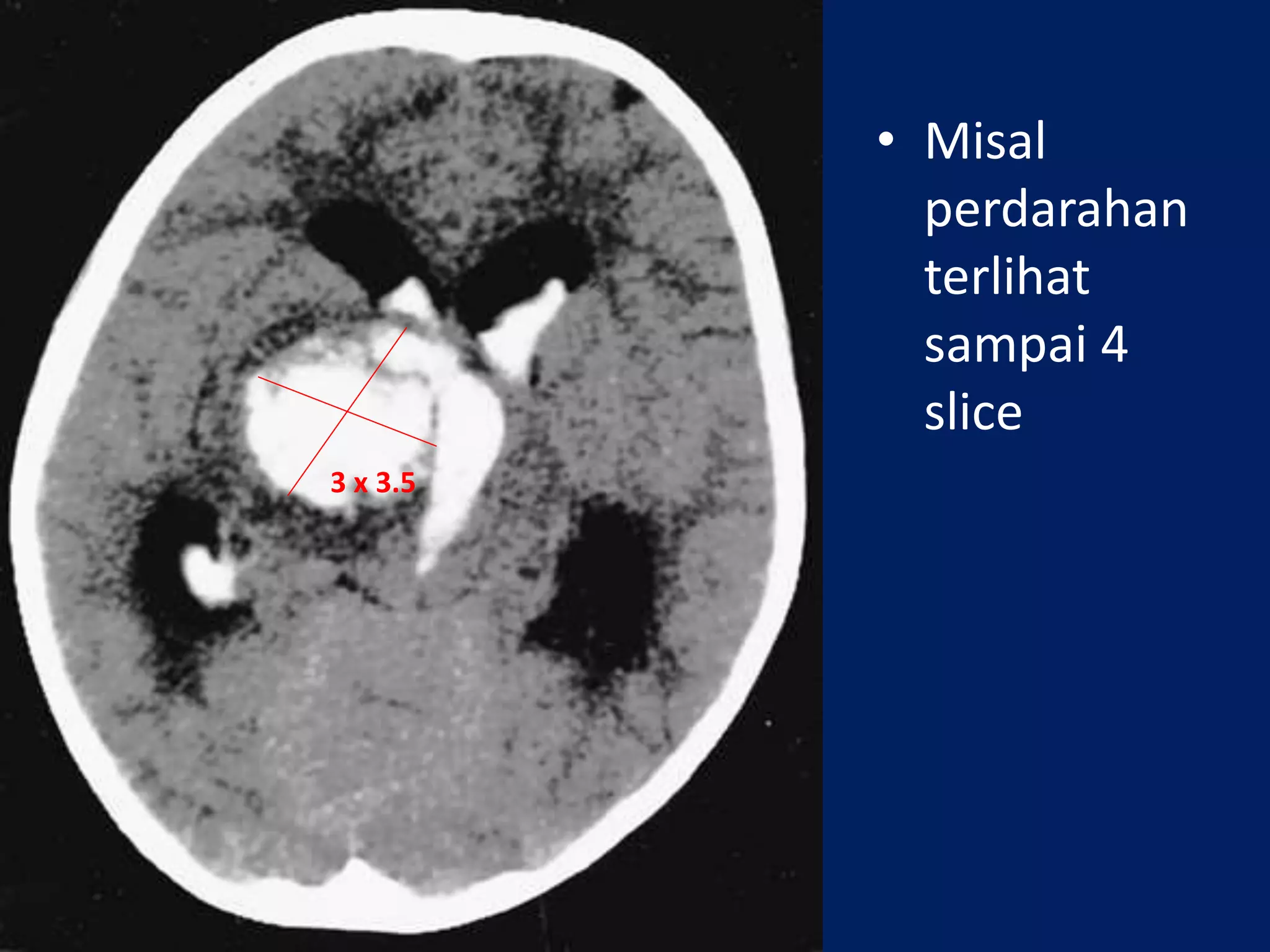 Baca ct scan | PPTX