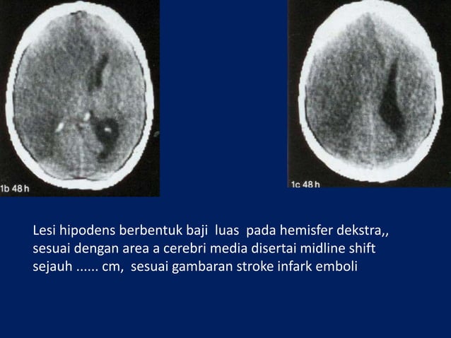 Baca ct scan | PPTX