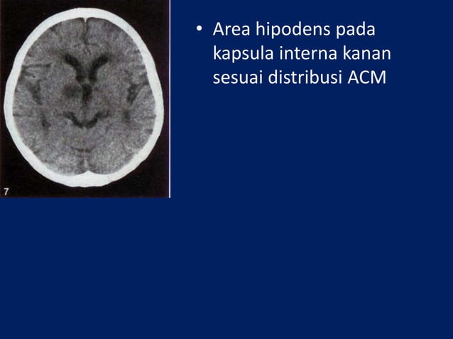 Baca ct scan | PPTX