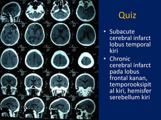 Baca ct scan | PPTX